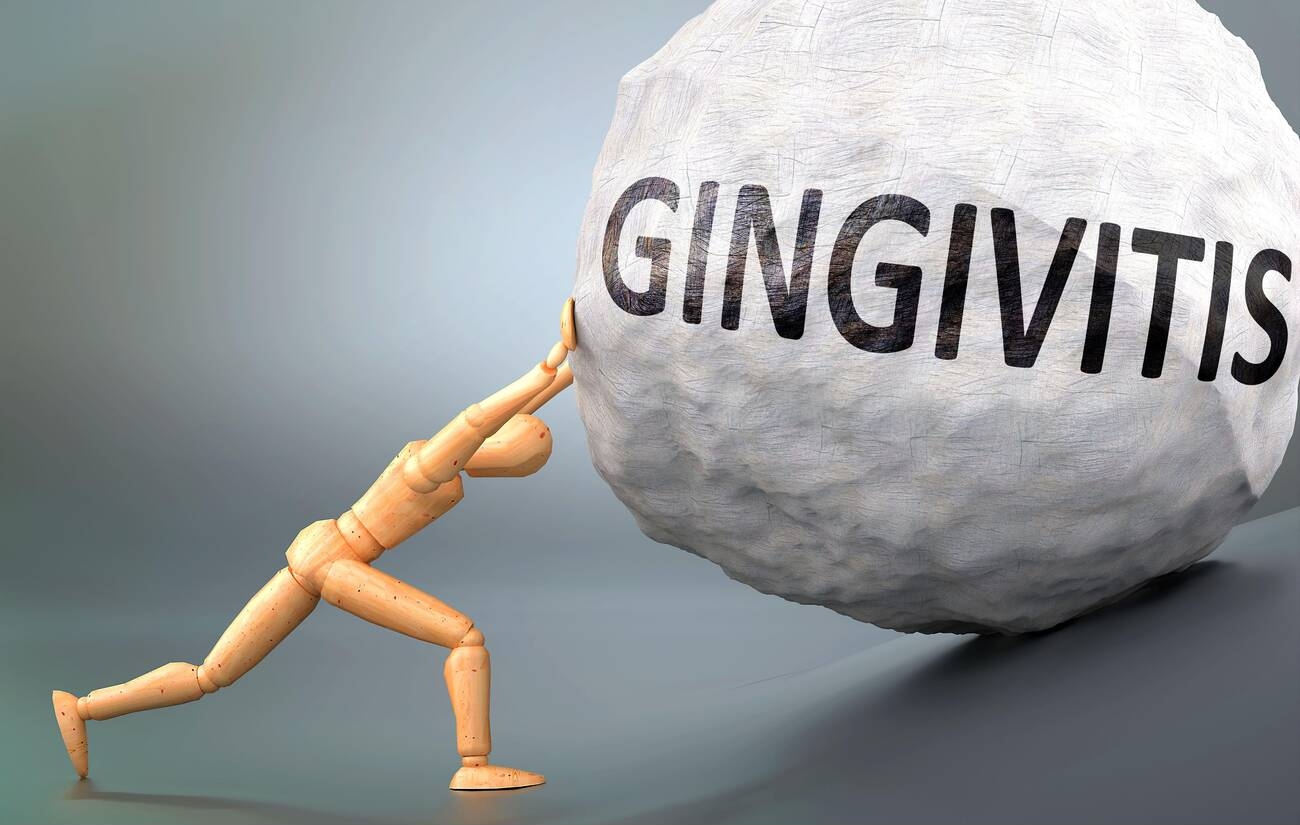 Can You Reverse Gingival Recession? Honest Answers + Easy Fixes